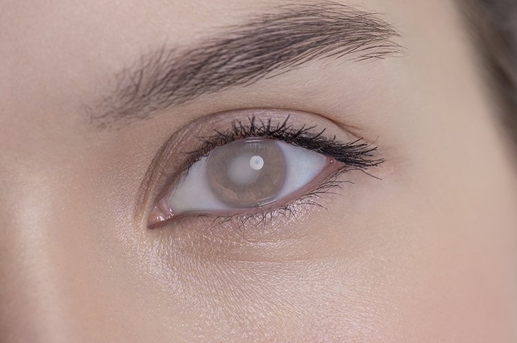 ICR Offers Refractive and Visual Improvements, But … - Ophthalmology 360