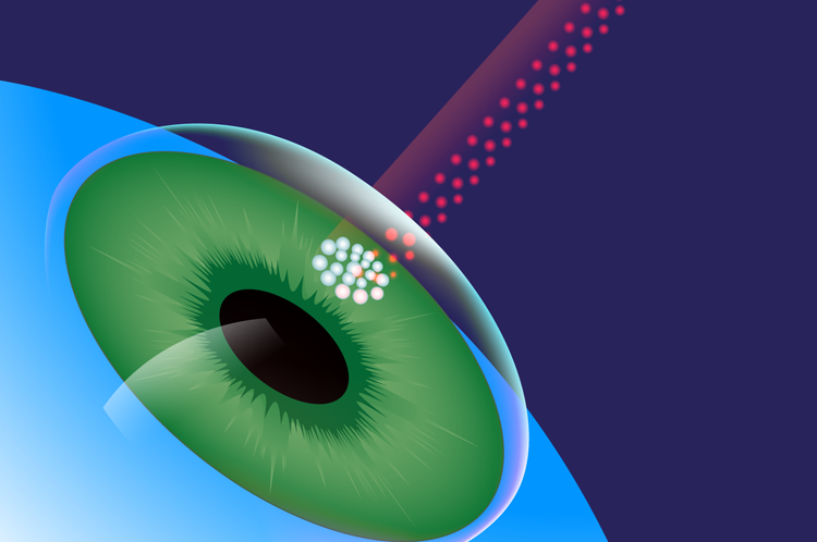 Ocular Bandage Gel Results Reported - Ophthalmology 360