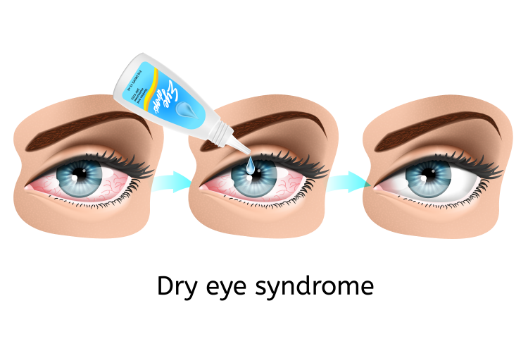 New Artificial Tear Formula Assessed - Ophthalmology 360