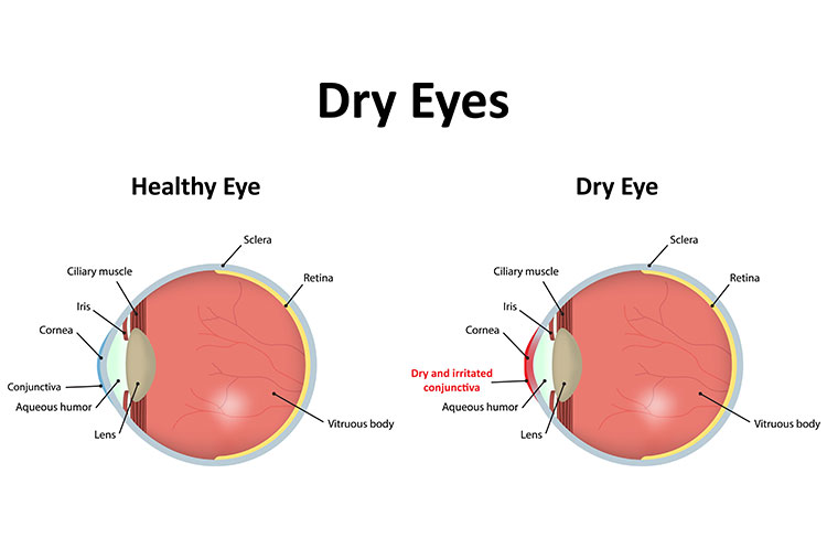Abnormal Osmolarity - Ophthalmology 360