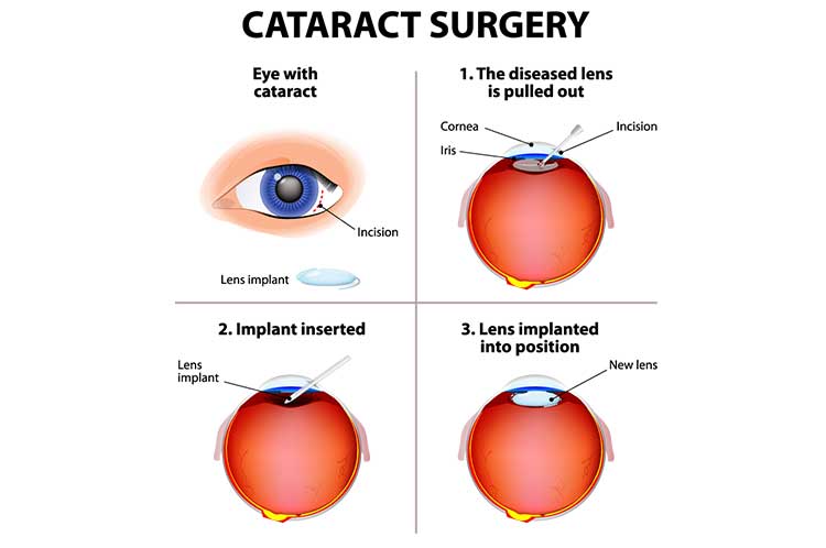 What Are the Latest Advances In Cataract Surgery? - Ophthalmology 360