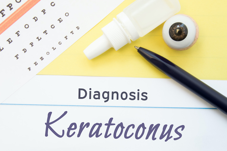 Monitoring Keratoconus Progression with Belin ABCD Staging ...