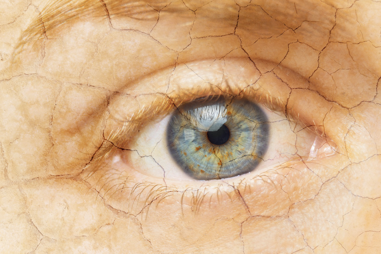 First patient dosed in phase 2 trial for chronic dry eye disease ...