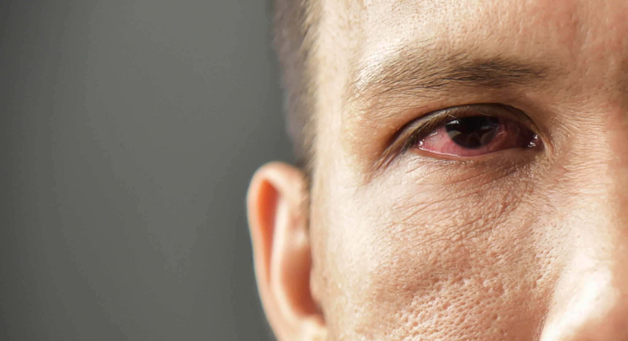 Study investigates features of dry eye disease flares - Ophthalmology 360