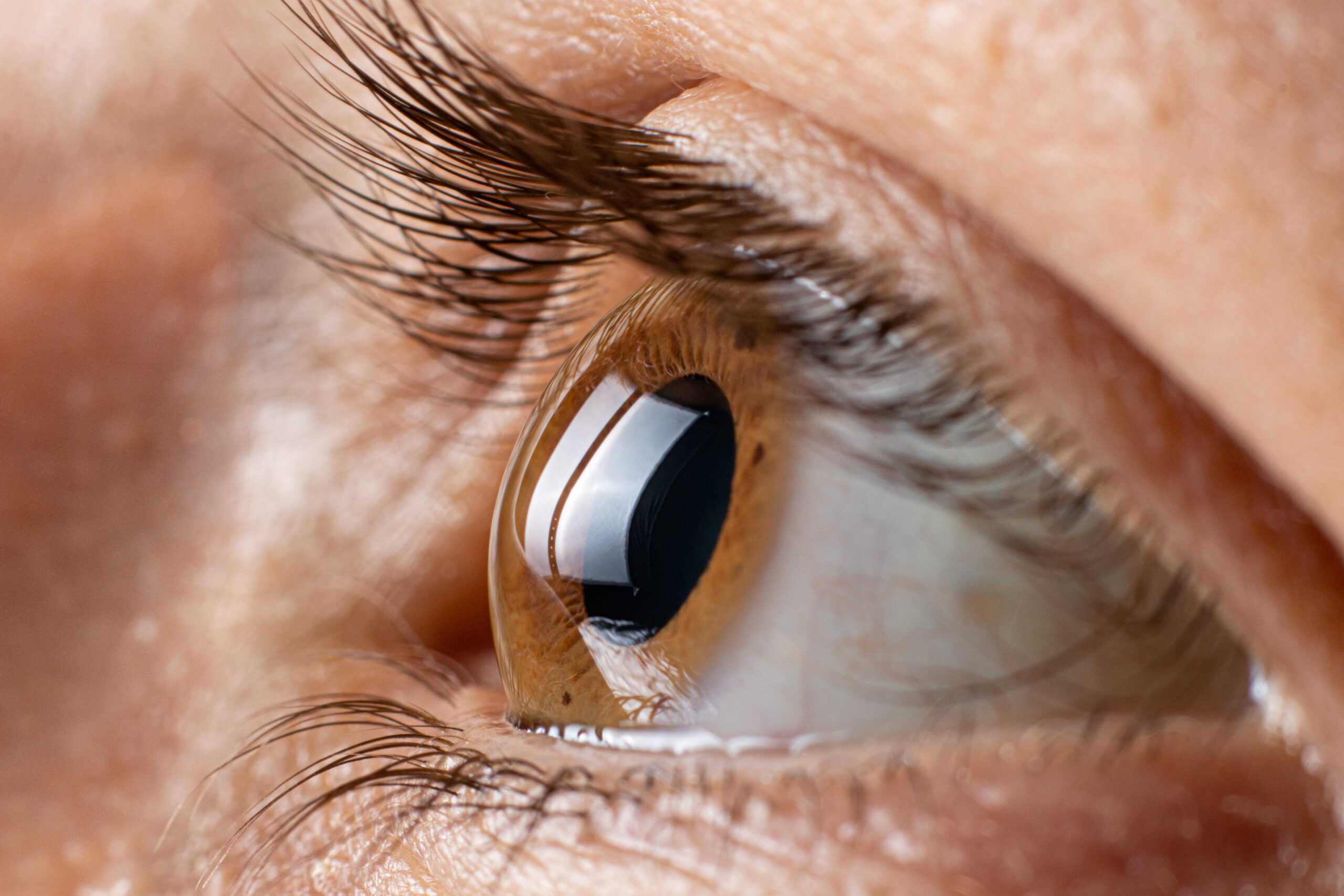 Presbyopia correction for complex cornea patients may be close at hand ...