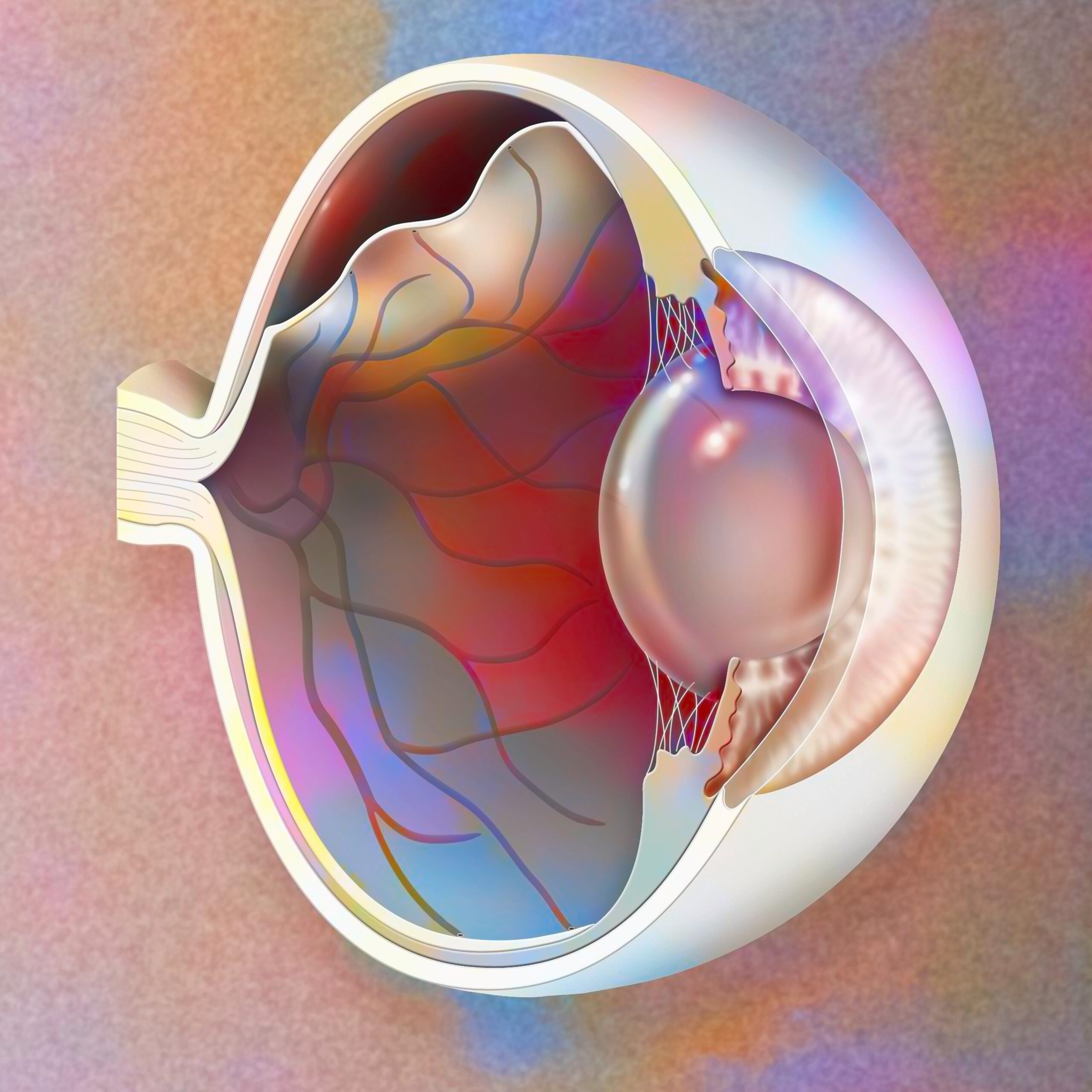 Retinal tears after cataract surgery often asymptomatic - Ophthalmology 360