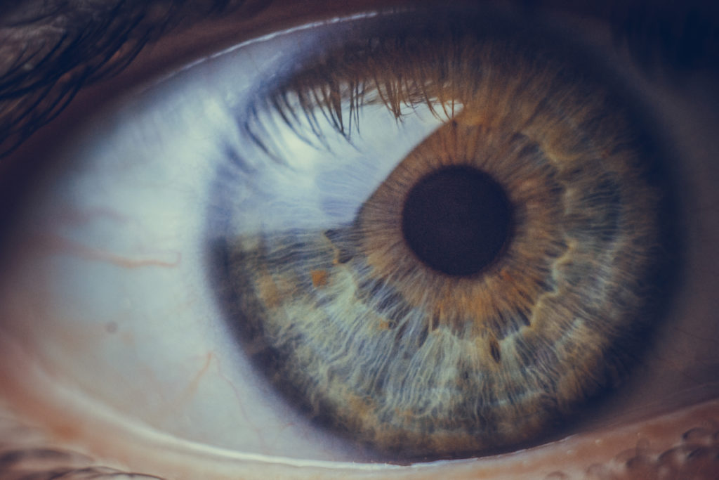 Micropulse transscleral laser lowers IOP in silicone oil-induced ...