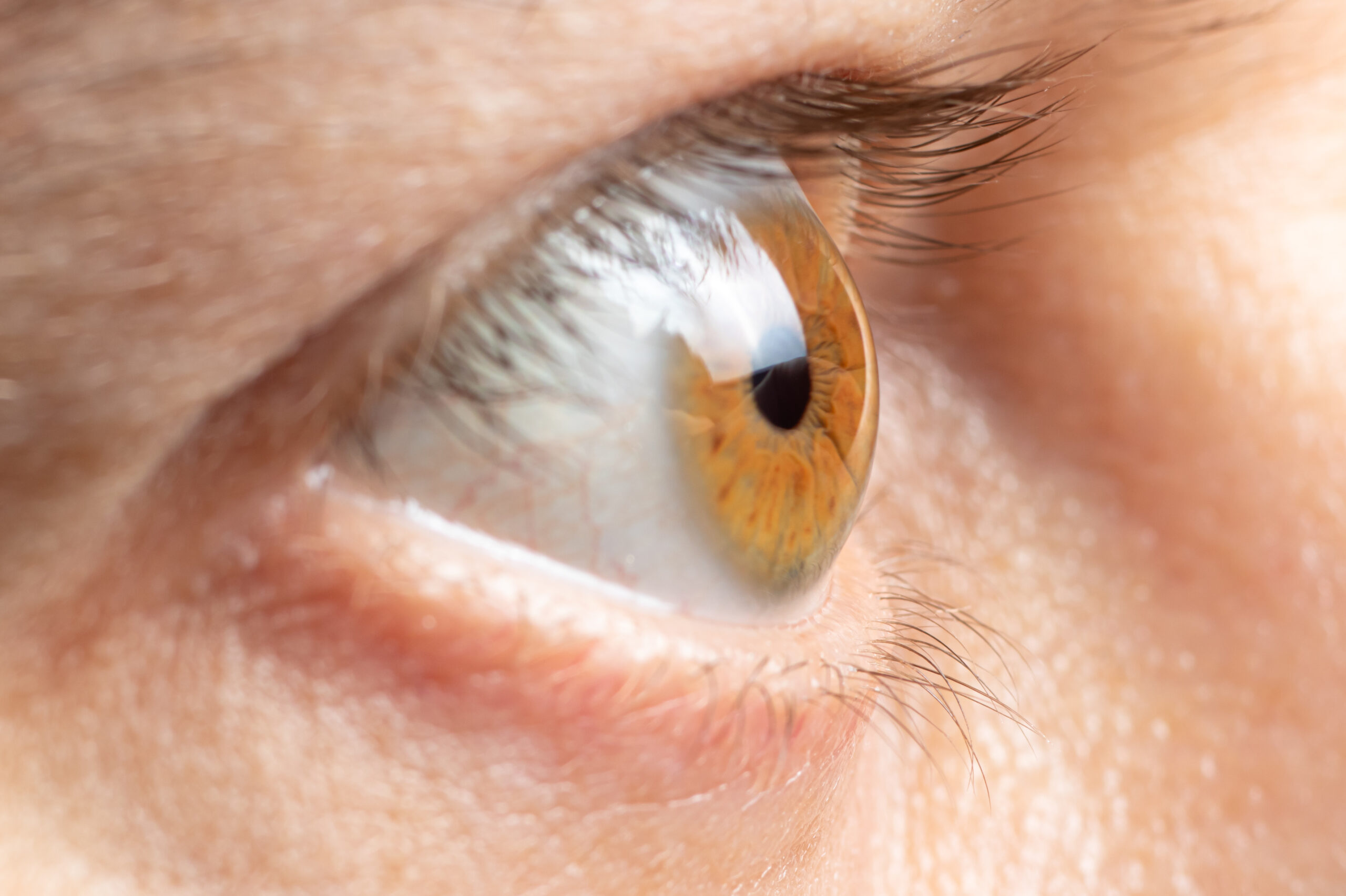 Study compares 180° vs 360° SLT in open angle glaucoma - Ophthalmology 360