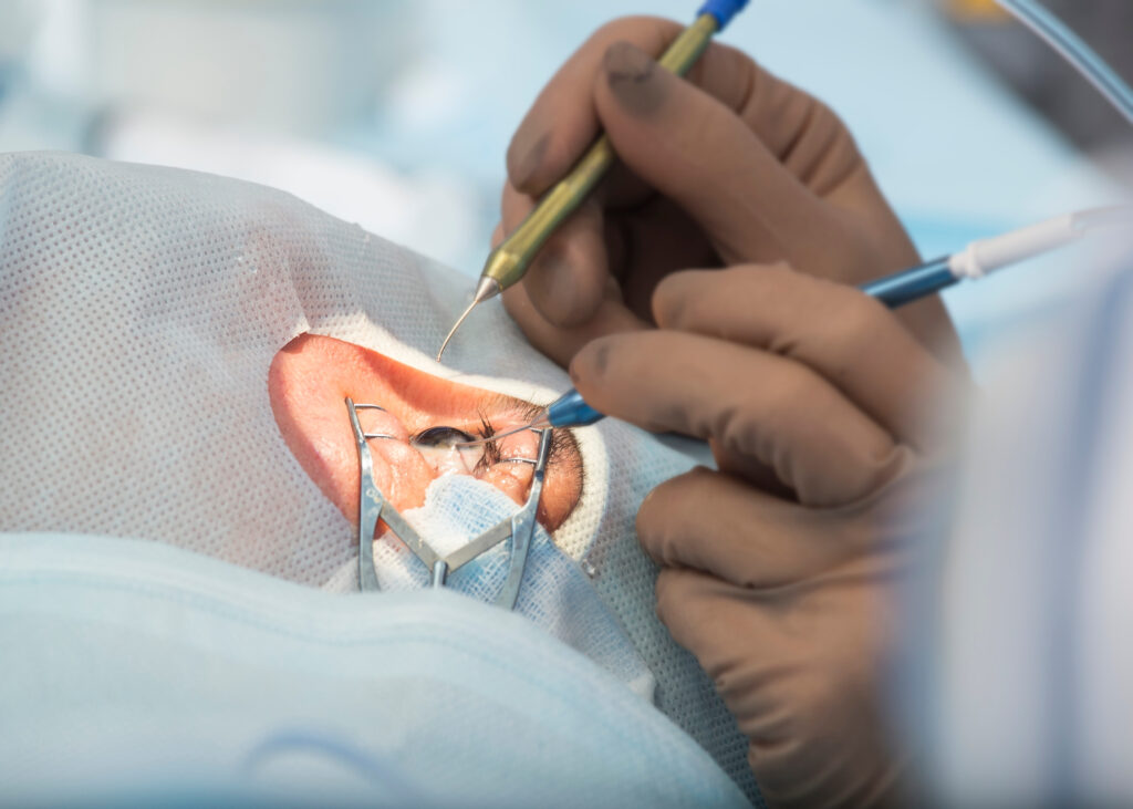 Bio-interventional cyclodialysis and cataract surgery approach ...