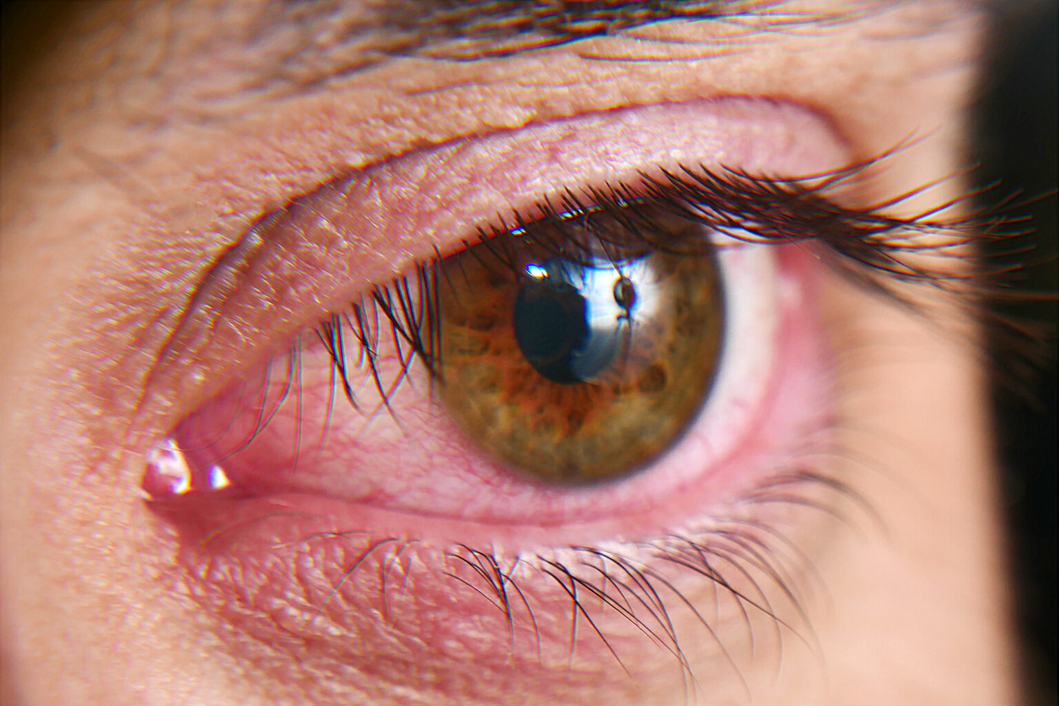 Patients with Graves' disease show high symptomatic rates of dry eye ...
