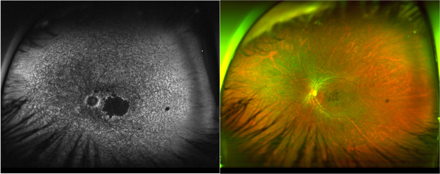 Breakthrough optogenetic therapy shows promise for Stargardt disease ...