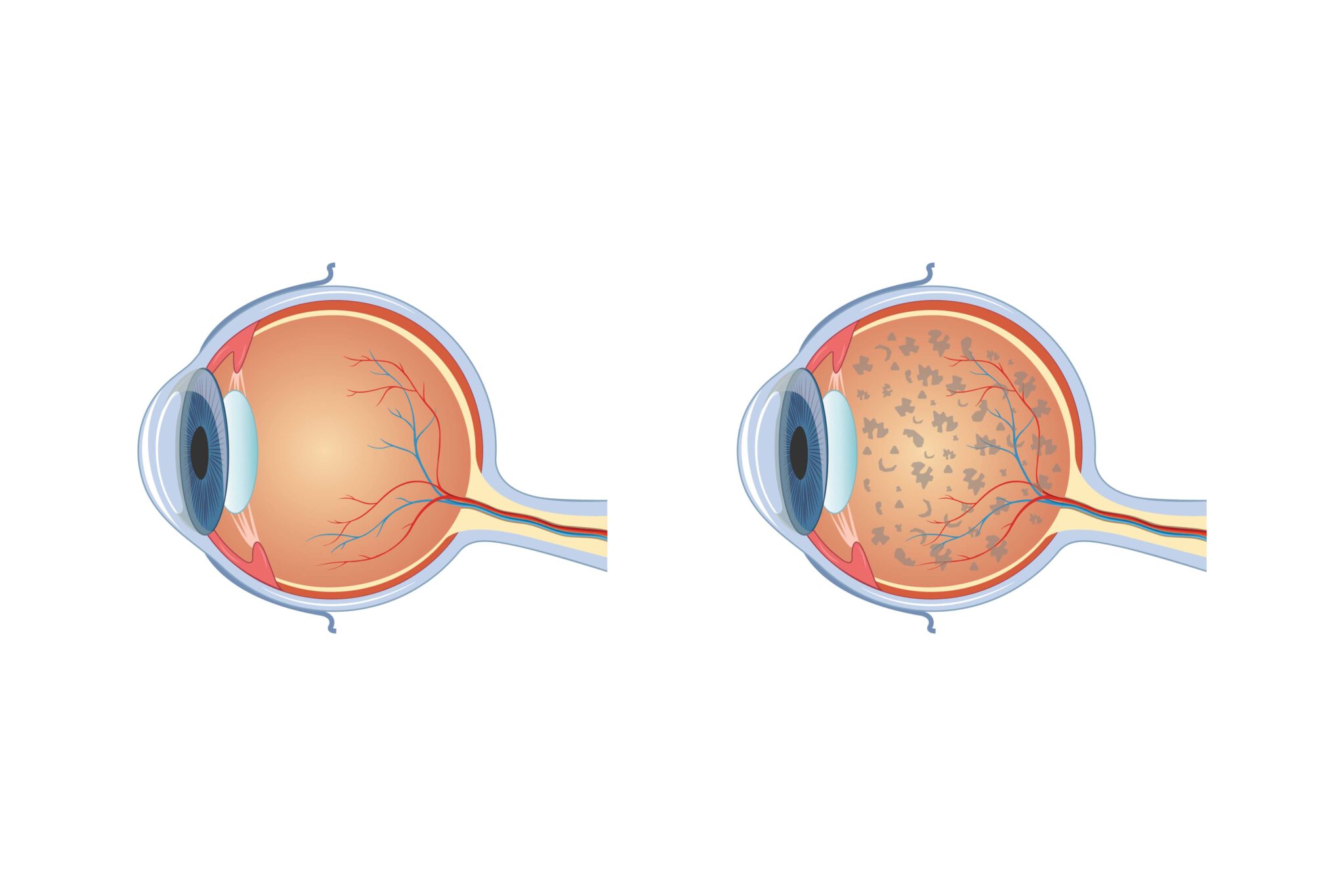 Subtenon PRP treatment shows visual improvements in patients with ...