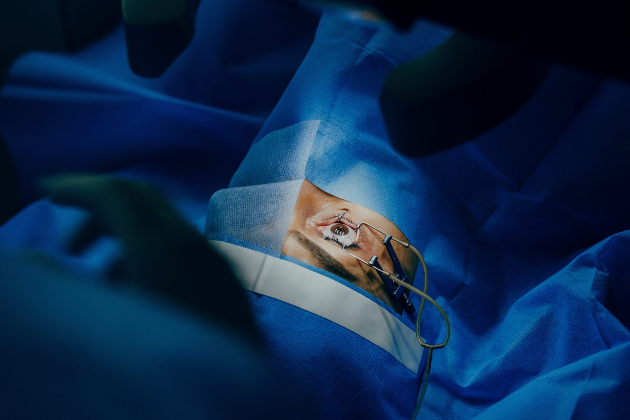 Novel gonio-intervention shows promise in open-angle glaucoma surgery ...