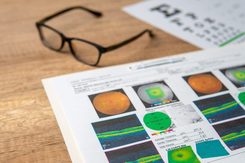 AS-OCT accurately detects early keratoconus through corneal epithelial ...