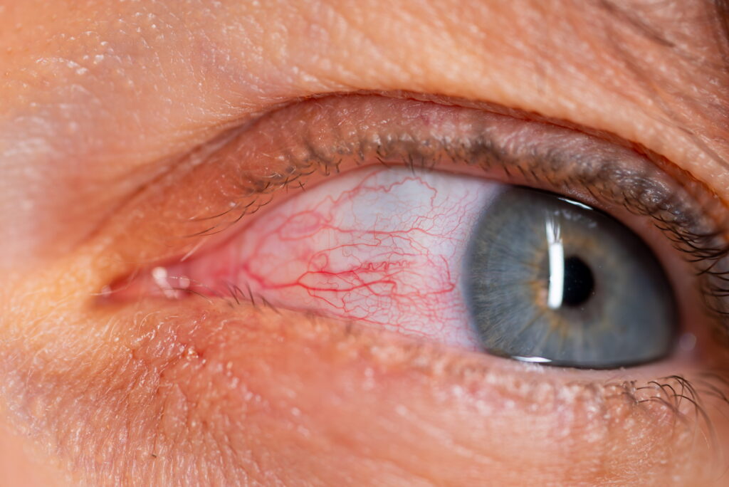 Infectious uveitis incidence varies by season in U.S - Ophthalmology 360